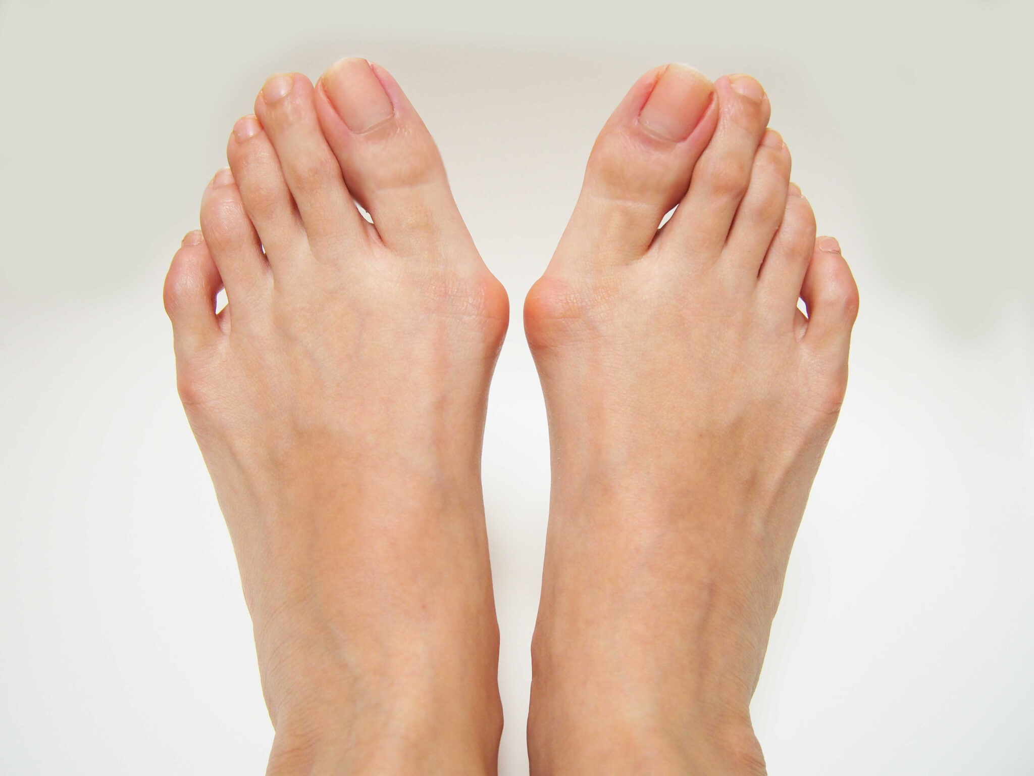 Bunion Treatment Sellersville | Hammertoe Blue Bell, Feasterville