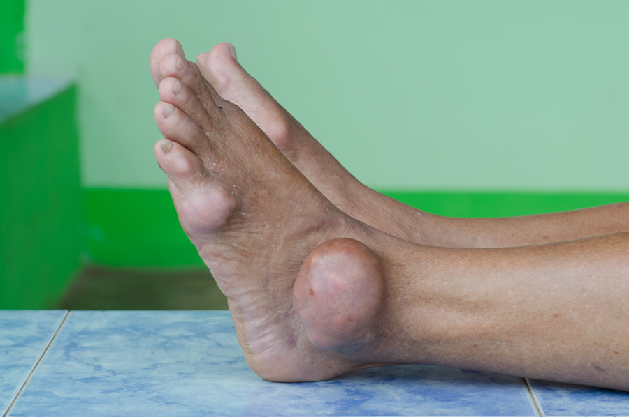 Gout Sellersville | Arthritis Blue Bell | Joint Pain Lansdale, PA